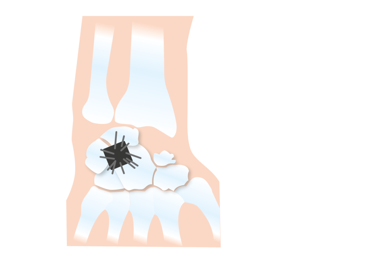 Institut Chirurgie de la main de Périgueux - Arthrose du poignet